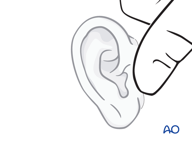 Bone anchored ear prosthesis for Pruzansky IIb