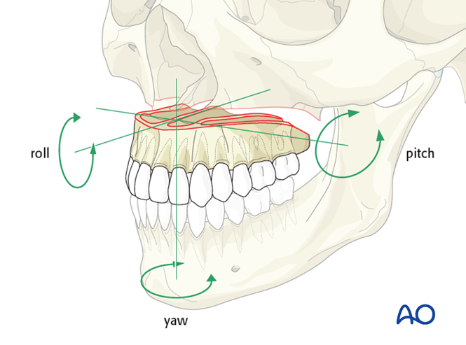 Rotational osteotomies including inverted L-osteotomy for Pruzansky IIa