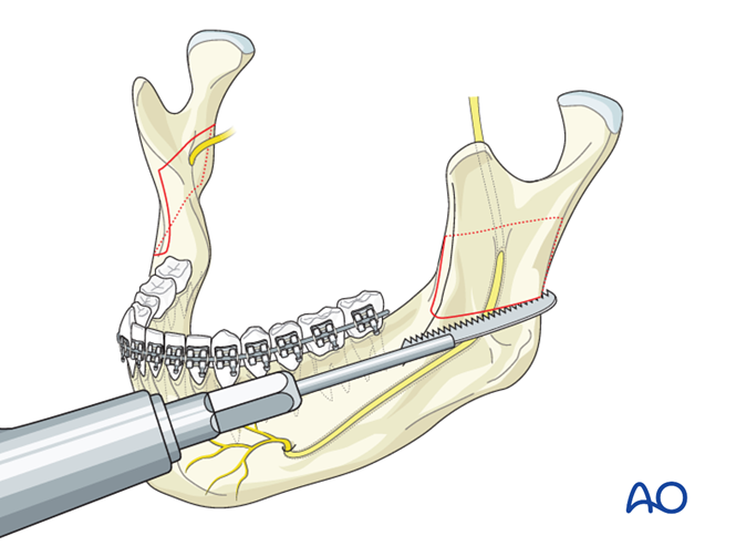 BSSO (Obwegeser) for Vertical mandibular hyperplasia
