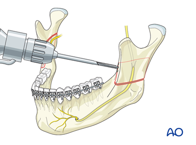 BSSO (Obwegeser) for Vertical mandibular hyperplasia