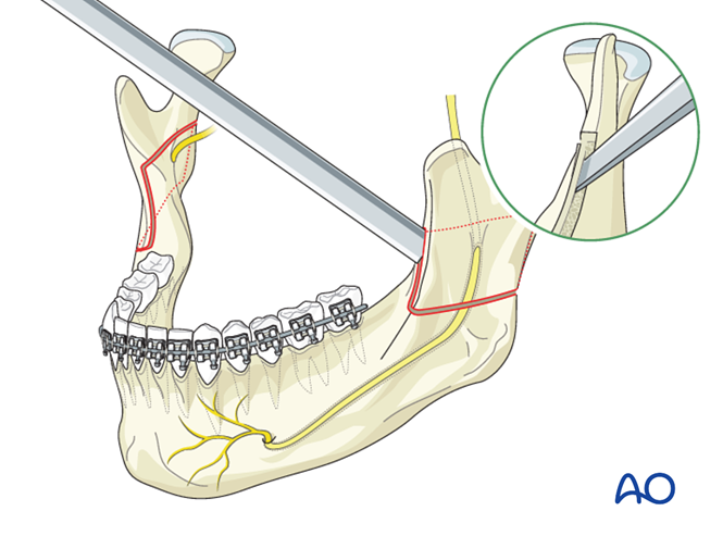 BSSO (Obwegeser) for Vertical mandibular hyperplasia
