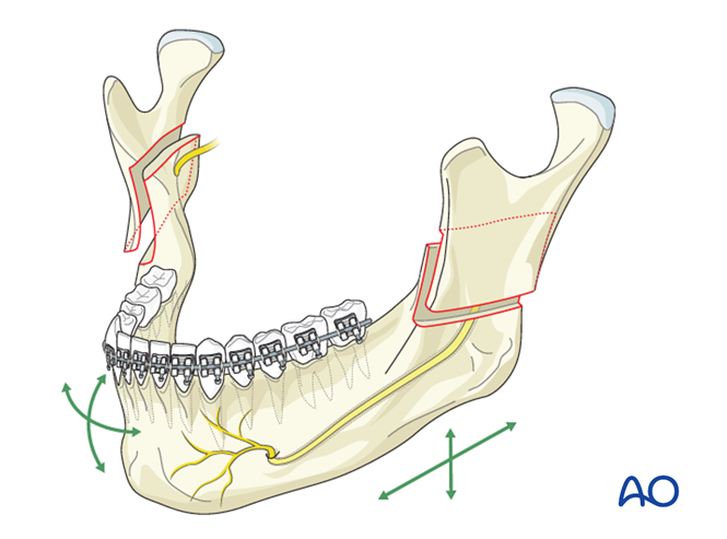 BSSO (Obwegeser) for Vertical mandibular hyperplasia