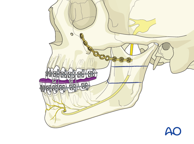 BSSO (Obwegeser) for Vertical mandibular hyperplasia