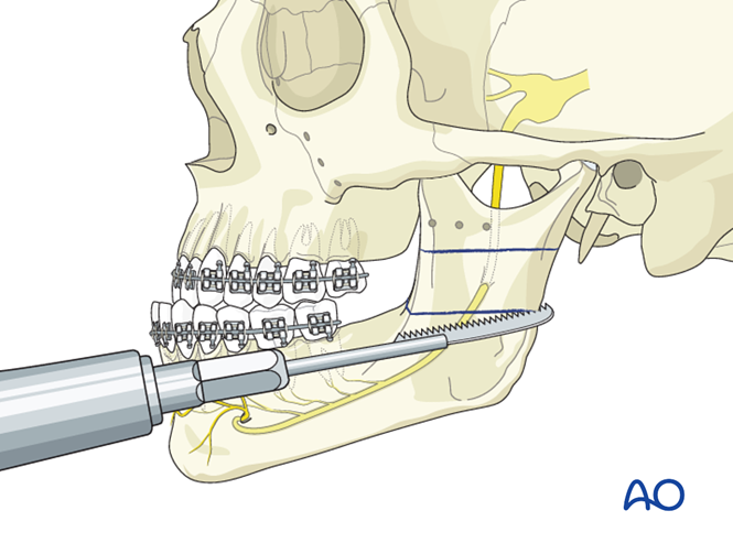 BSSO (Obwegeser) for Vertical mandibular hyperplasia