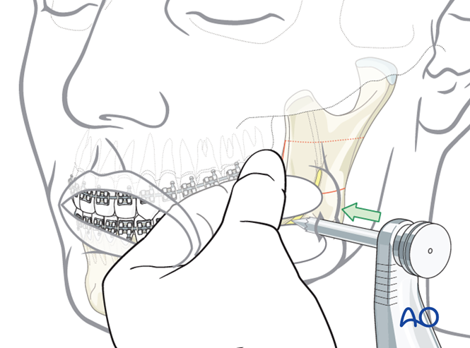 BSSO (Obwegeser) for Vertical mandibular hyperplasia