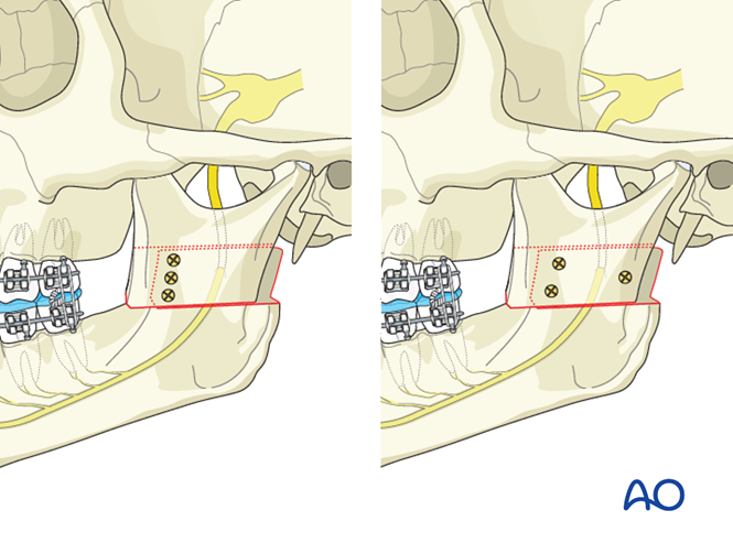 BSSO (Obwegeser) for Vertical mandibular hyperplasia