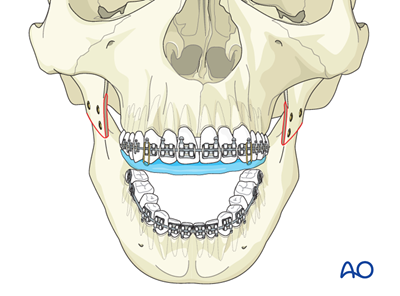 BSSO (Obwegeser) for Vertical mandibular hyperplasia