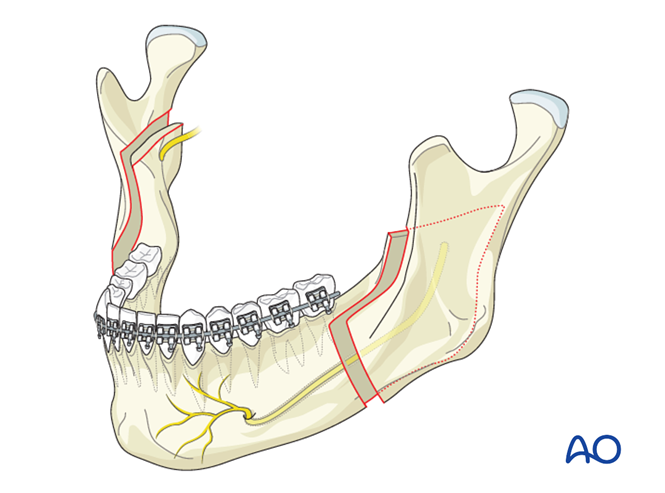 BSSO (Obwegeser, Dal Pont) for Mandibular retrognathism