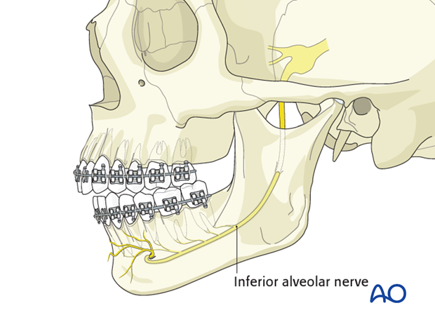 BSSO (Obwegeser, Dal Pont) for Laterognathia