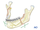 Treatment of Mandibular prognathism