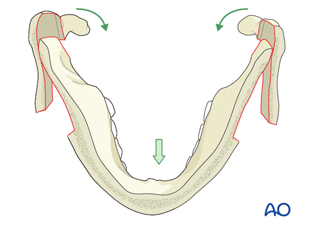 BSSO (Obwegeser, Dal Pont) for Laterognathia