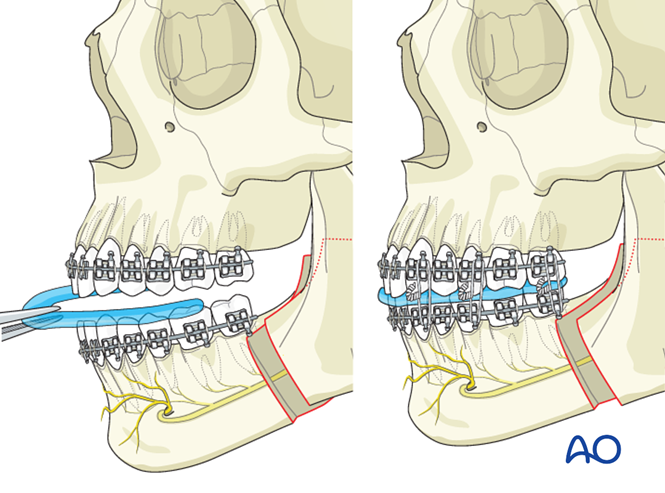 BSSO (Hunsuck) for Mandibular prognathism