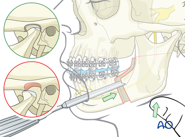 BSSO (Obwegeser, Dal Pont) for Laterognathia