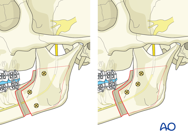 BSSO (Obwegeser, Dal Pont) for Laterognathia