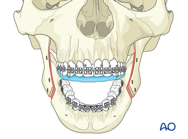 BSSO (Obwegeser, Dal Pont) for Laterognathia