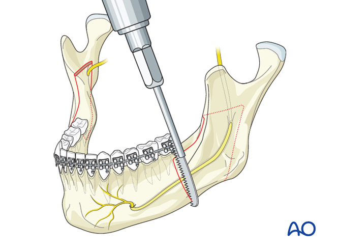 BSSO (Hunsuck) for Vertical mandibular hyperplasia