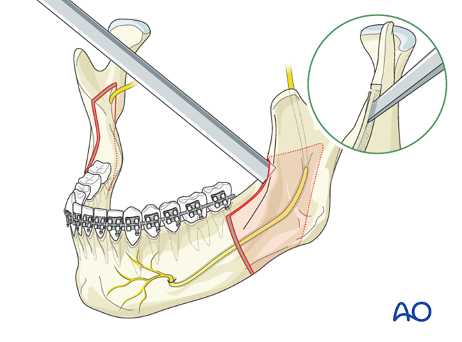 BSSO (Hunsuck) for Vertical mandibular hyperplasia