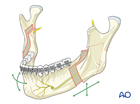 Treatment of Mandibular retrognathism