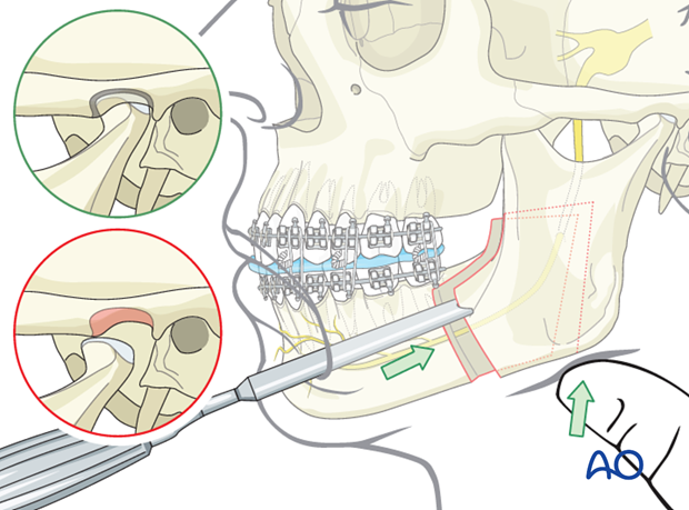 BSSO (Hunsuck) for Vertical mandibular hyperplasia