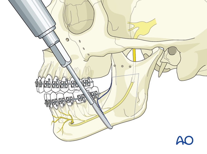 BSSO (Hunsuck) for Vertical mandibular hyperplasia