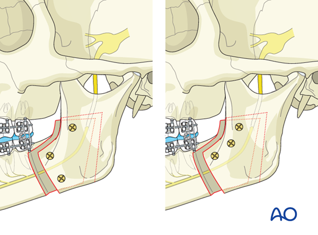 BSSO (Hunsuck) for Mandibular prognathism