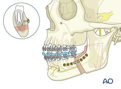 BSSO (Hunsuck) for Vertical mandibular hyperplasia