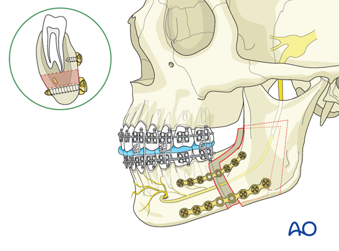 BSSO (Hunsuck) for Vertical mandibular hyperplasia