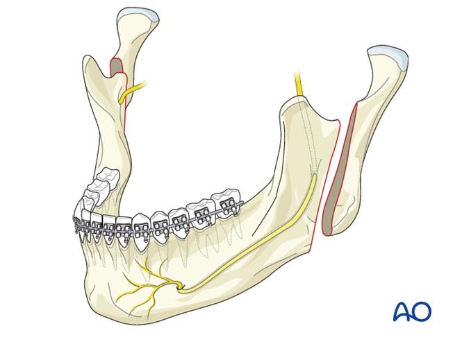Vertical ramus osteotomy for Laterognathia