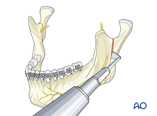 Vertical ramus osteotomy for Laterognathia