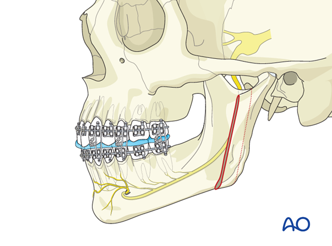 Vertical ramus osteotomy for Vertical mandibular hyperplasia