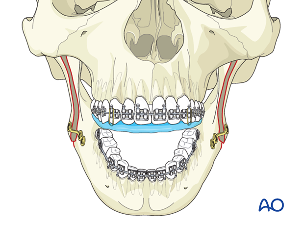 Vertical ramus osteotomy for Laterognathia