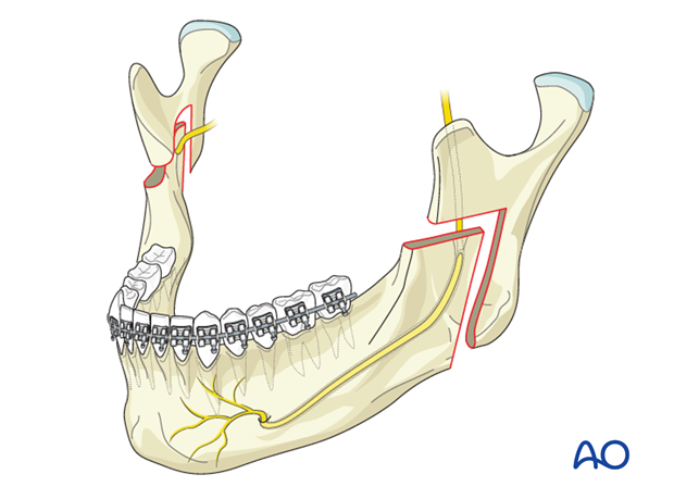 Inverted L osteotomy for Mandibular prognathism