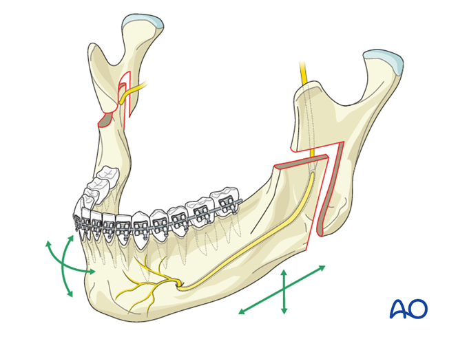 Inverted L osteotomy for Vertical mandibular hyperplasia