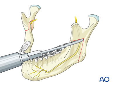 Inverted L osteotomy for Vertical mandibular hypoplasia