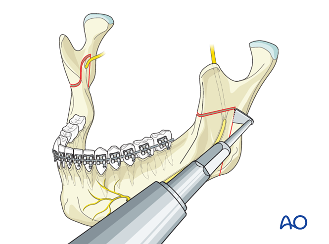 Inverted L osteotomy for Condylar hyperplasia