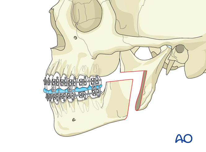 Inverted L osteotomy for Vertical mandibular hyperplasia