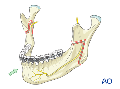 Inverted L osteotomy for Laterognathia