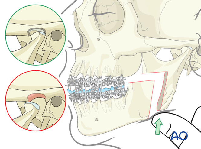 Inverted L osteotomy for Laterognathia