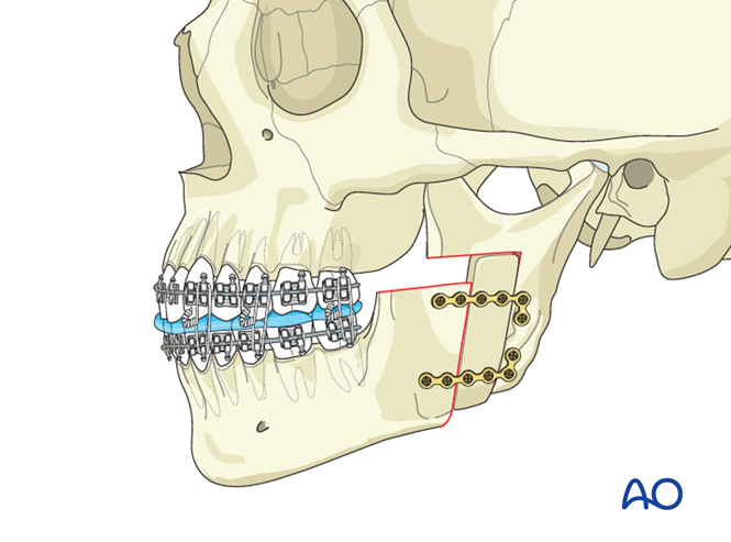 Inverted L osteotomy for Mandibular prognathism