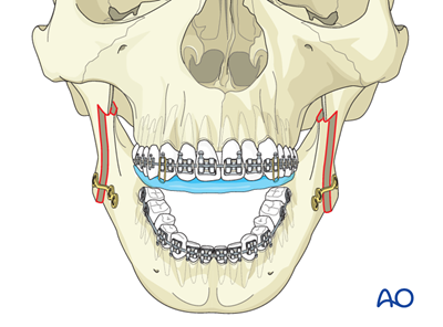 Inverted L osteotomy for Laterognathia