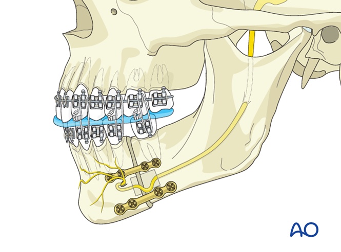 Mandibular body osteotomy (Dingman) for Mandibular retrognathism