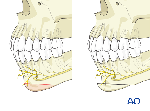 Chin osteotomy for Progenia