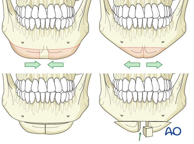 Chin osteotomy for Progenia