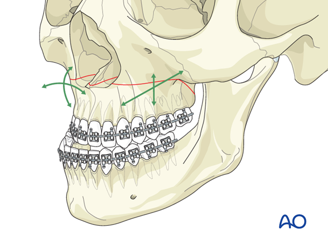 Le Fort I osteotomy for Maxillary retrognathism