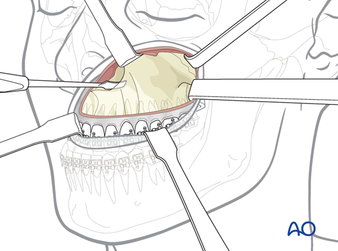 Le Fort I osteotomy for Maxillary prognathism