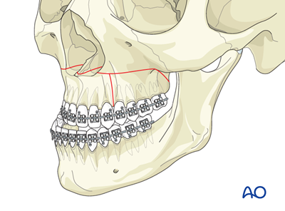 Le Fort I osteotomy for Maxillary prognathism