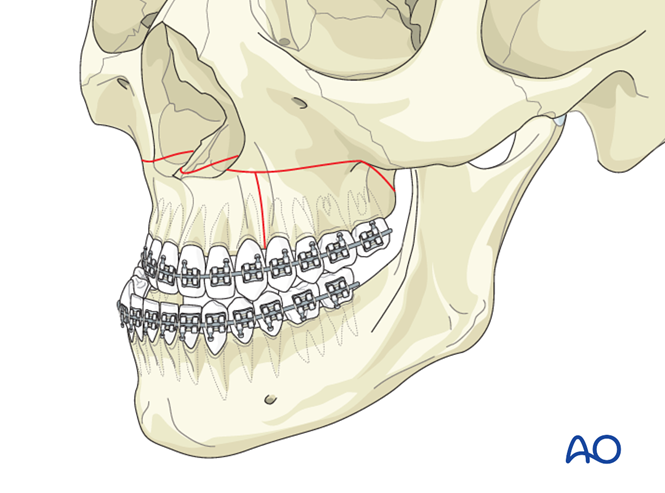 Le Fort I osteotomy for Maxillary retrognathism