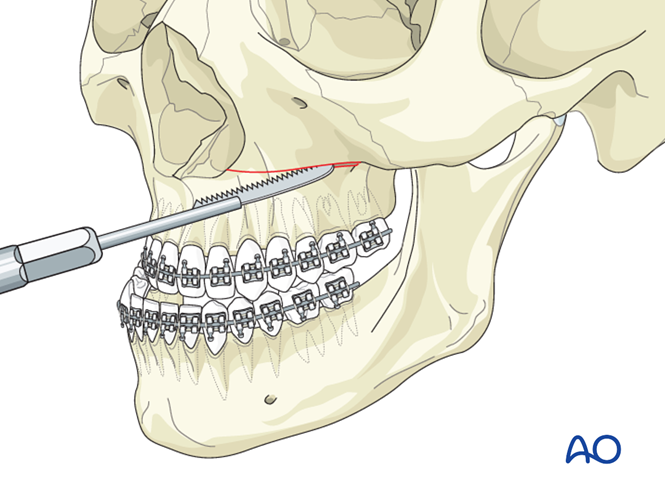 Le Fort I osteotomy for Maxillary retrognathism