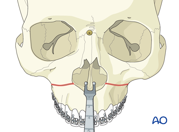 Le Fort I osteotomy for Maxillary prognathism
