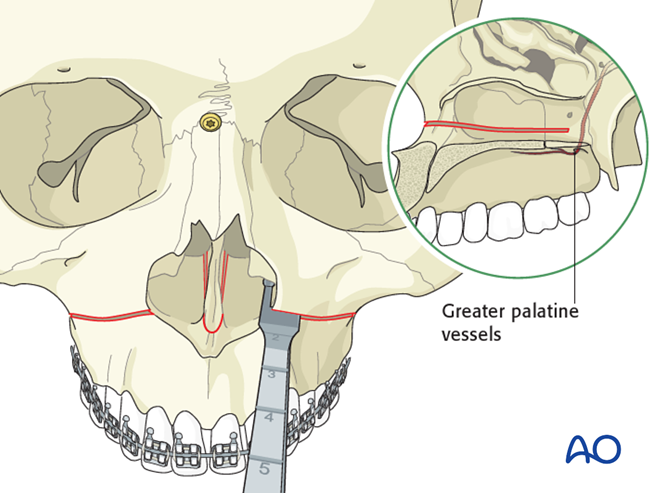 Surgically assisted rapid palatal expansion for Transverse hypoplasia ...